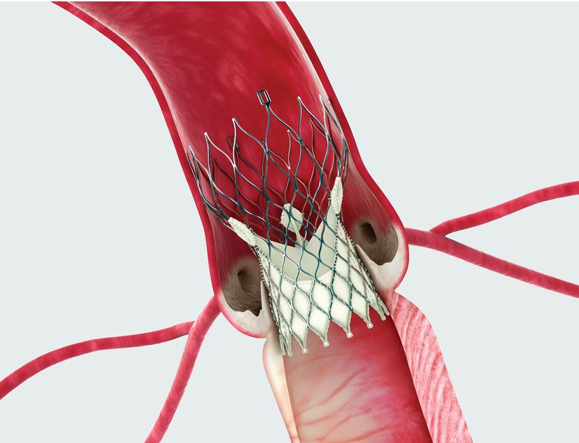 בשורות טובות למדטרוניק - מדינט - בריאות ורפואה